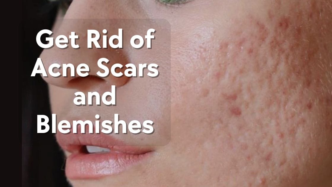 How to Get Rid of Acne Scars and Blemishes